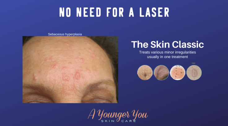Sebaceous Hyperplasia: Causes and Treatments – Skin Care Tips and News